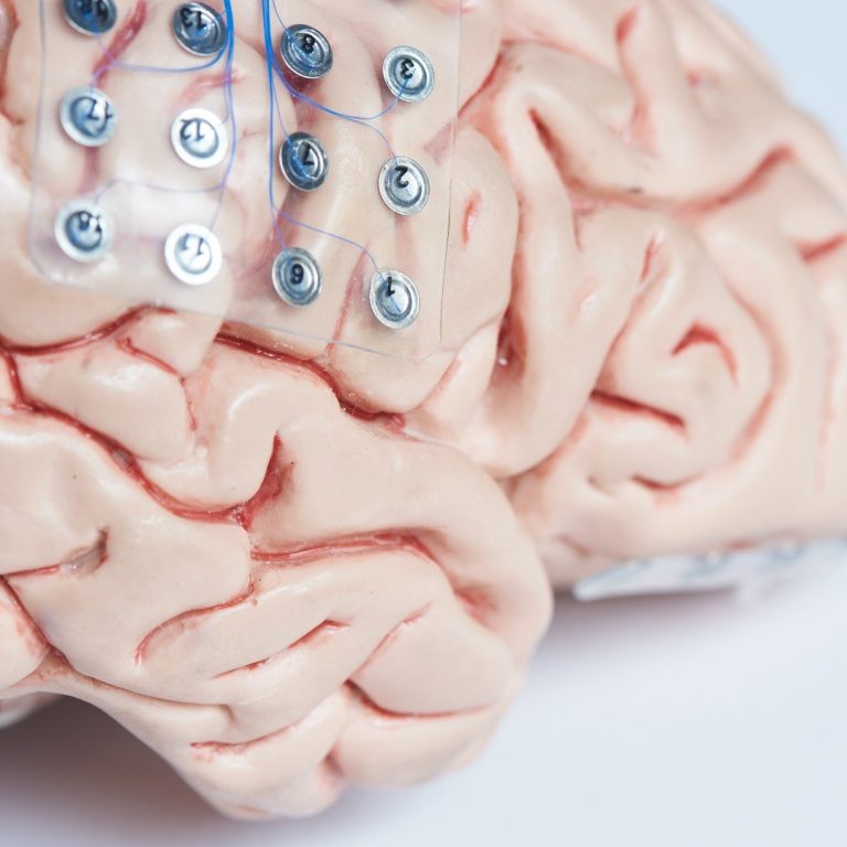 Craniotomy for Subdural Grids, Strips, Depth-Electrodes | NSPC Brain ...