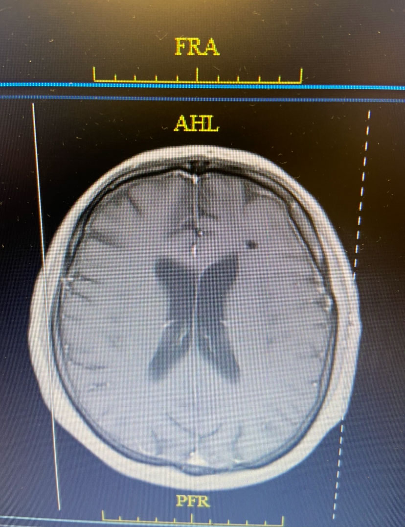 50 year old man with new onset aphasia and a left frontal mass / Brain ...