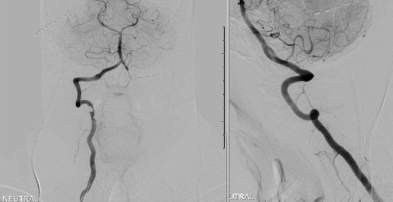 Right Vertebral Artery Compression Syndrome | NSPC Brain & Spine Surgery