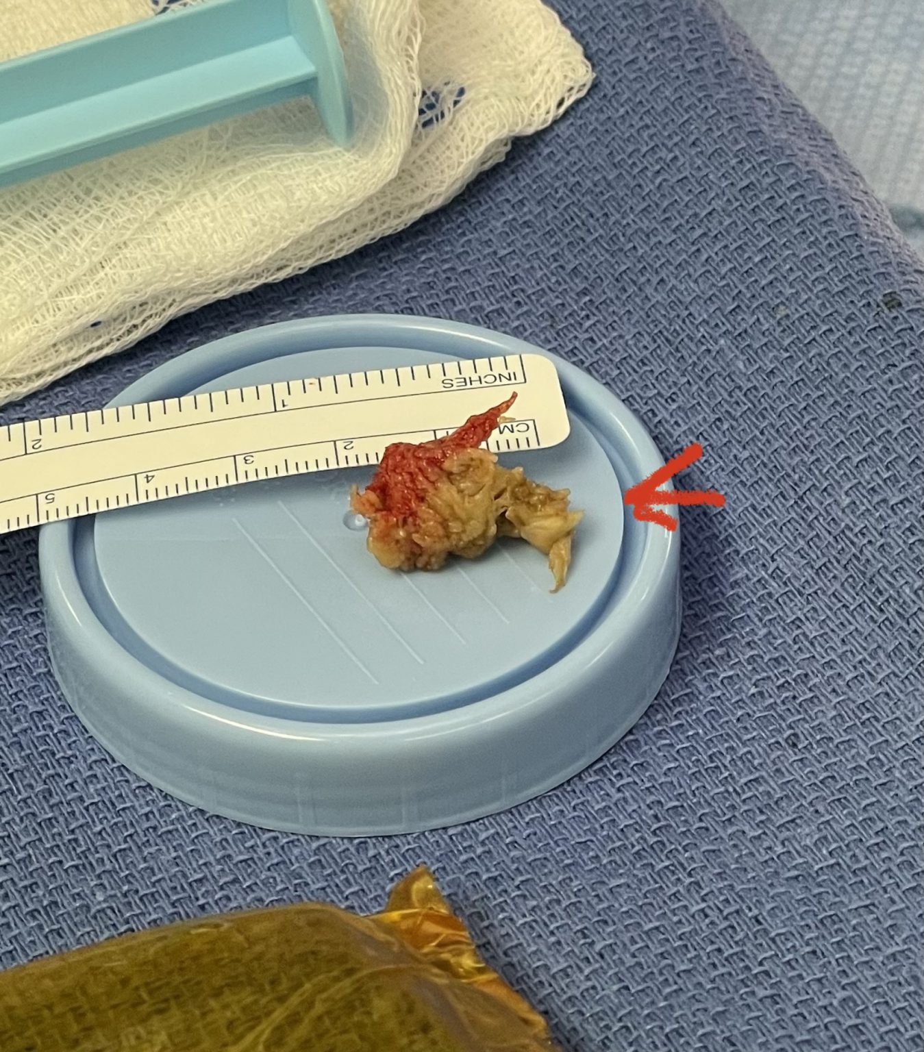 Lateral Disc Herniations | NSPC Brain & Spine Surgery