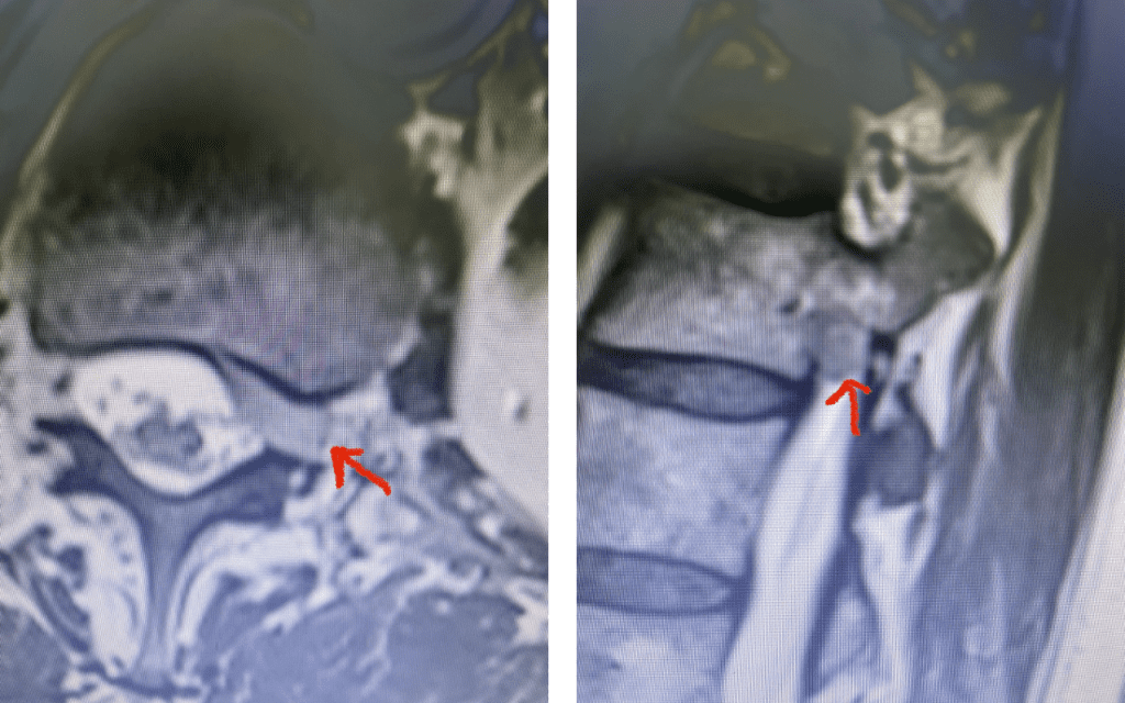Lateral Disc Herniations | NSPC Brain & Spine Surgery
